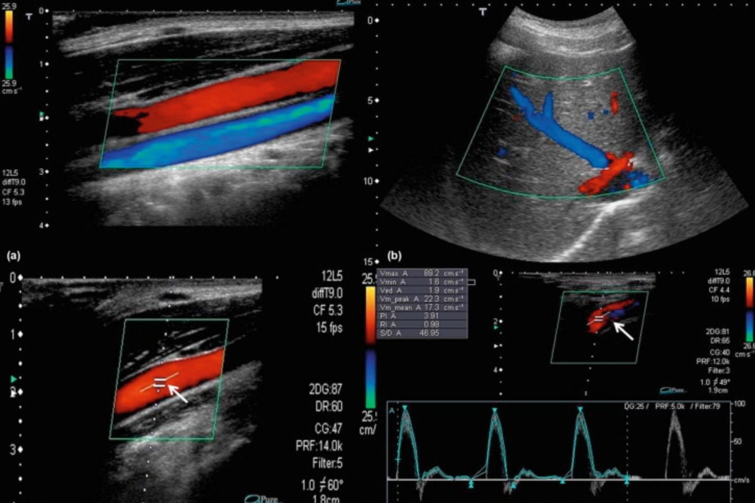 Unlocking Precision: Edan's Color Flow Doppler Tech